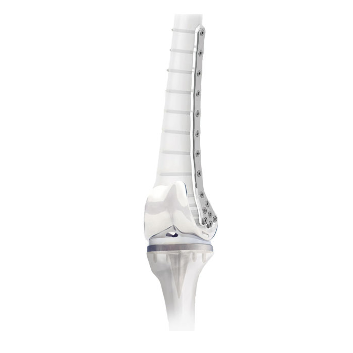 Distal Femur Periarticular Plate - CliniLab