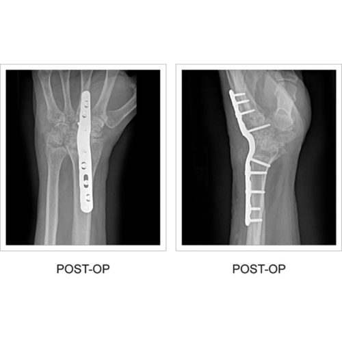 TriMed Total Wrist Fusion Plate - CliniLab