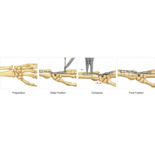 TriMed Total Wrist Fusion Plate - CliniLab