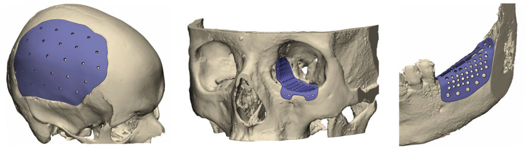 Custom-made Implants - CliniLab