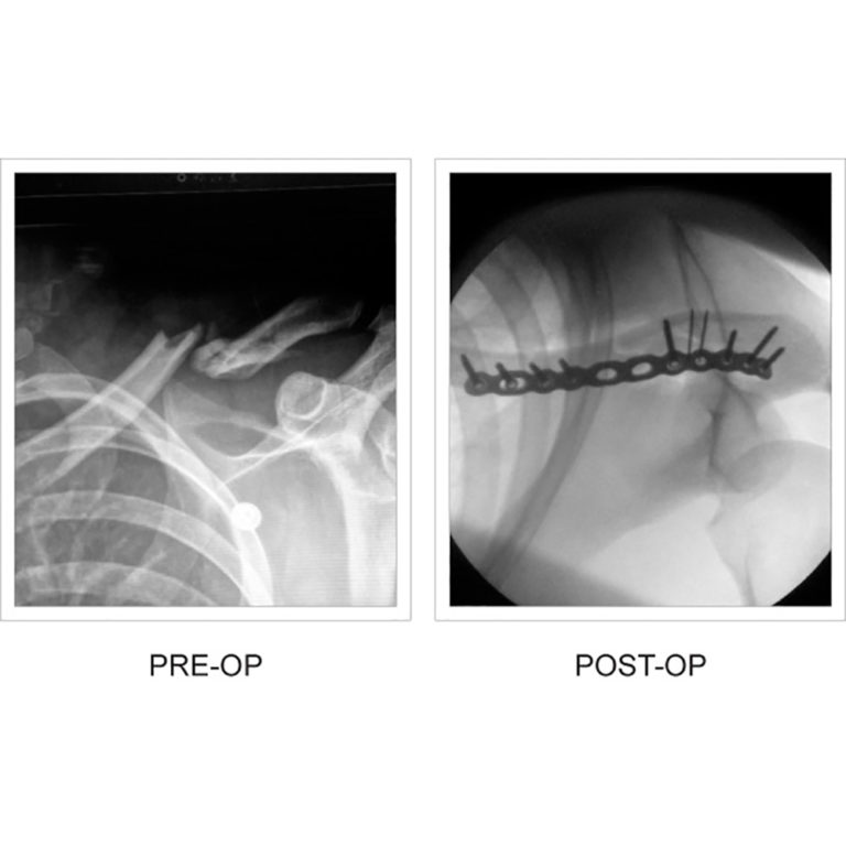 TriMed Clavicle Plate System - CliniLab