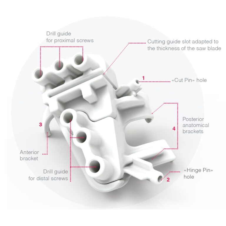 ACTIVMOTION High Tibial Osteotomy Plate & PSI - CliniLab