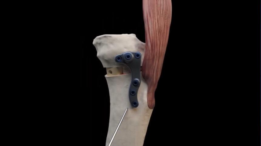 ACTIVMOTION High Tibial Osteotomy Plate & PSI - CliniLab